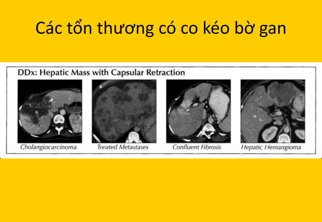 Clvt trong cđ u gan 2 | PPTX