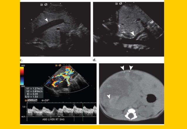 Clvt trong cđ u gan 2 | PPTX