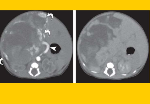 Clvt trong cđ u gan 2 | PPTX