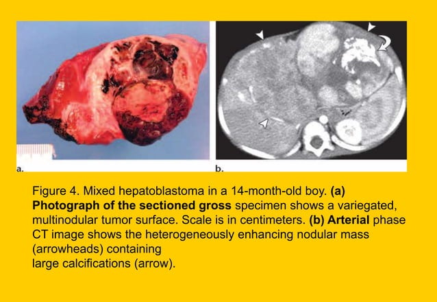 Clvt trong cđ u gan 2 | PPTX