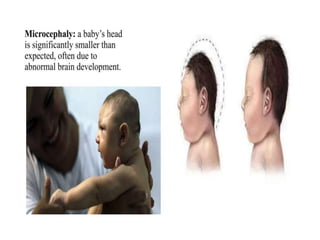 congenital Malformations-Neural tube defectsAnencephaly, | PPTX