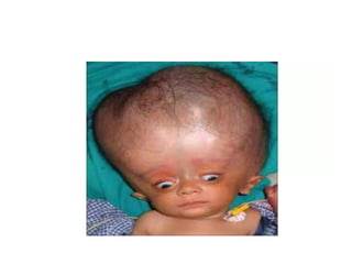 congenital Malformations-Neural tube defectsAnencephaly, | PPTX