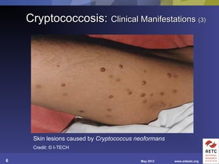 Cryptococcal meningitis Prepared by gabbyM | PPT