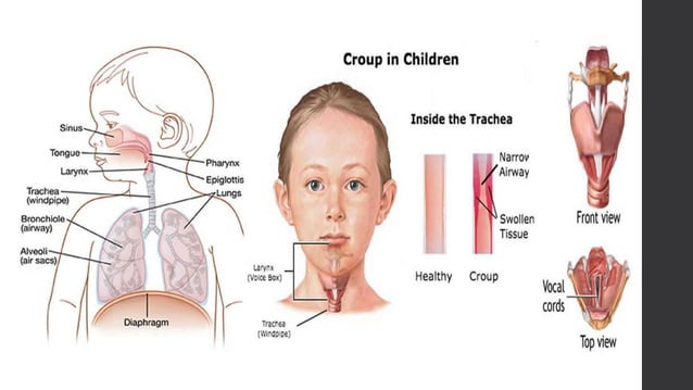 CM Acute Laryngeo-trachea Bronchitis.pptx | Lung and Respiratory Health ...