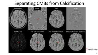 Cerebral Microbleed Detection using Susceptibility Weighted Imaging and ...