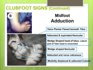 Ponseti Management of Clubfoot in Chittagong Division: Experience of ...