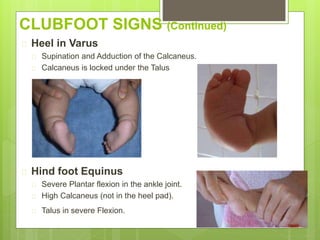 Ponseti Management of Clubfoot in Chittagong Division: Experience of ...