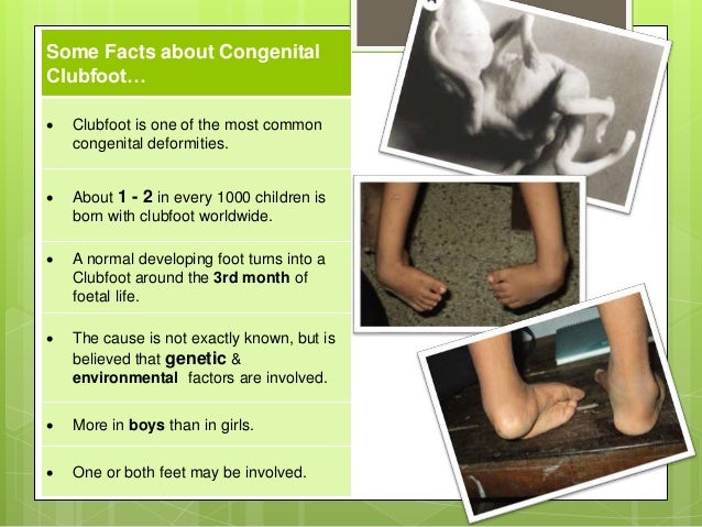 Ponseti Management of Clubfoot in Chittagong Division: Experience of