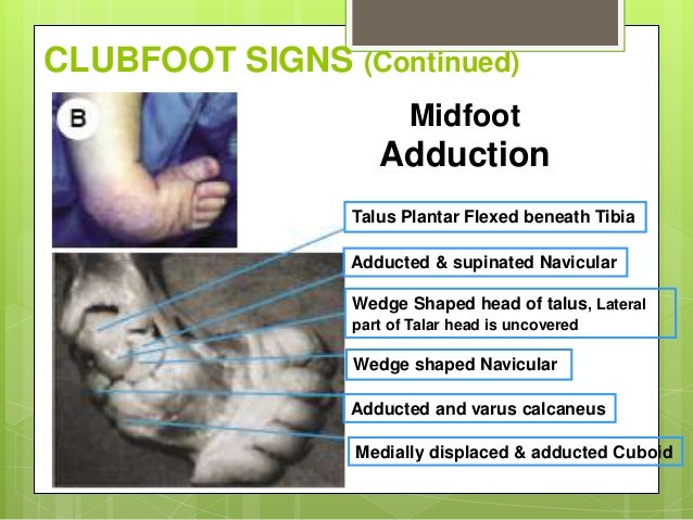 Ponseti Management of Clubfoot in Chittagong Division: Experience of