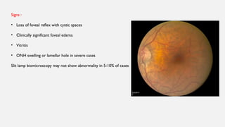 Pseudophakic cystoid macular edema case presentation | PPTX
