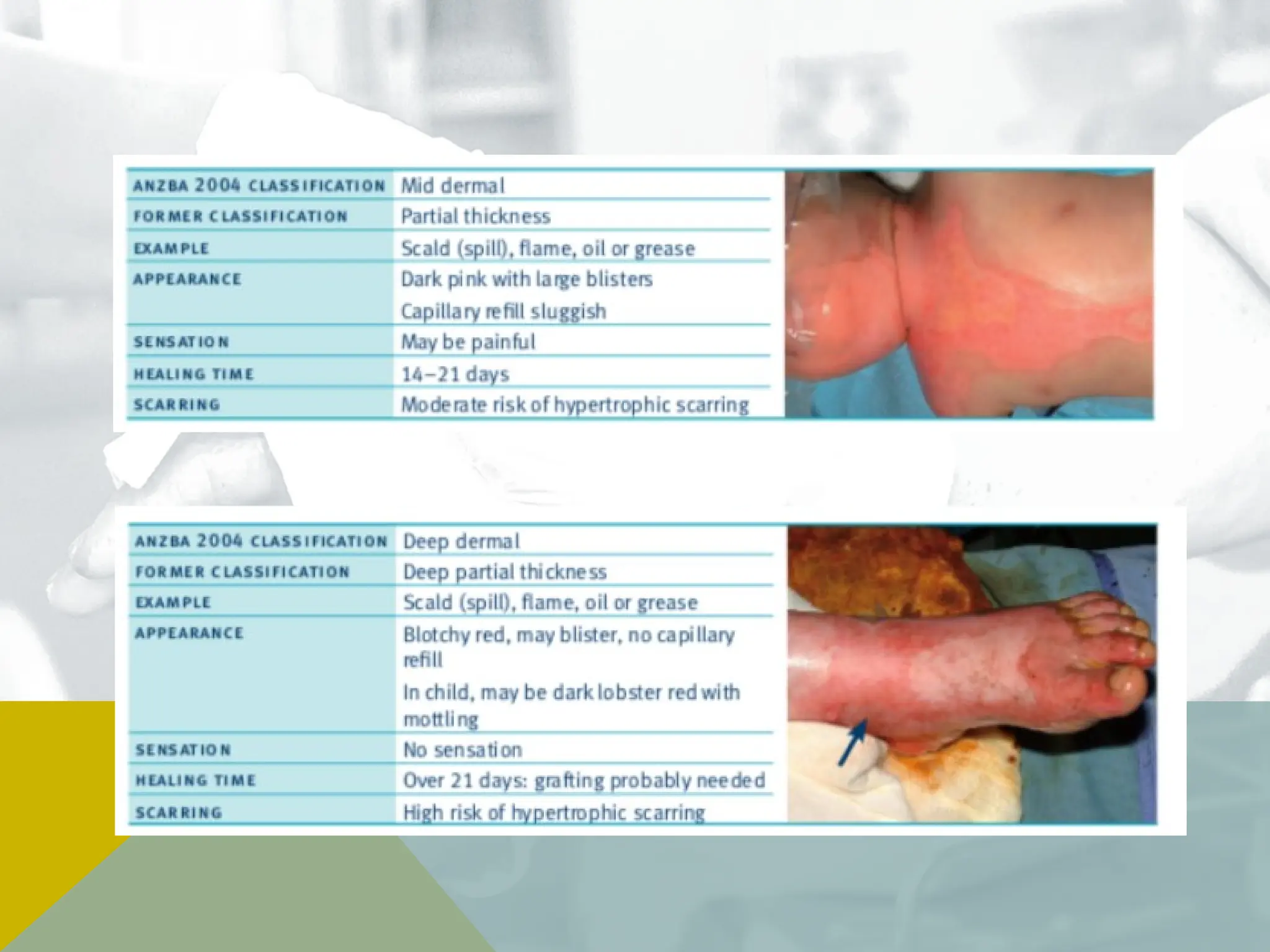 CONTINOUS MEDICAL EDUCATION OF BURN (SURGICAL) | PPTX