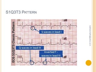Cardiac monitoring & ECG | PPTX