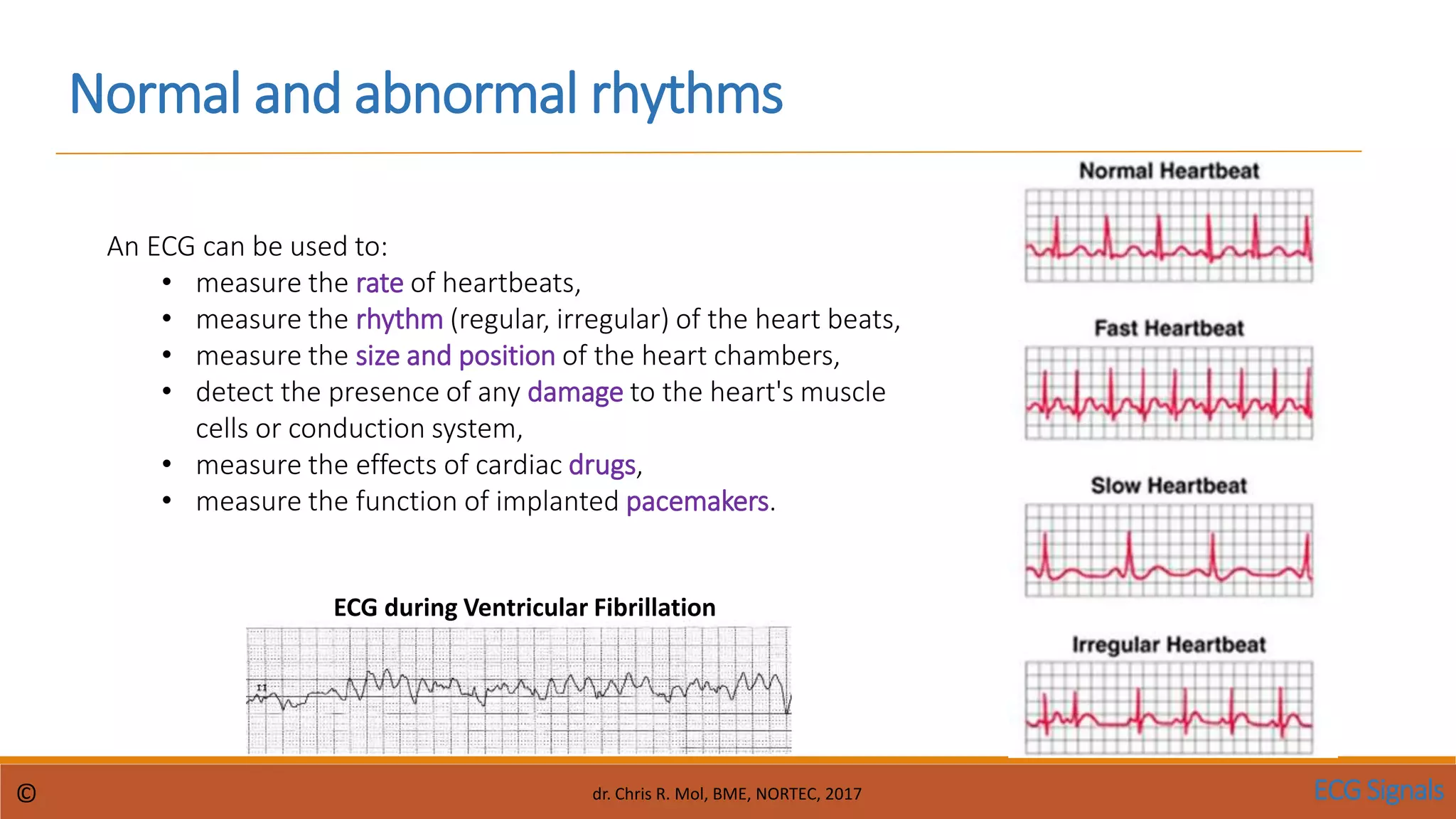 CM ECG Signals pp.pptx