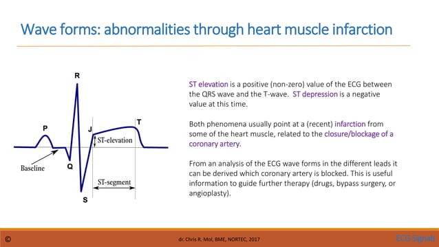 CM ECG Signals pp.pptx