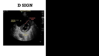pulmonary embolism diagnosis and management | PPT