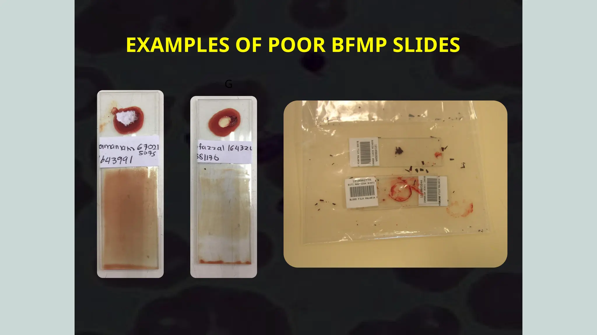 blood film malaria parasite collection, transportation & slide ...