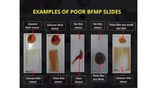 blood film malaria parasite collection, transportation & slide ...