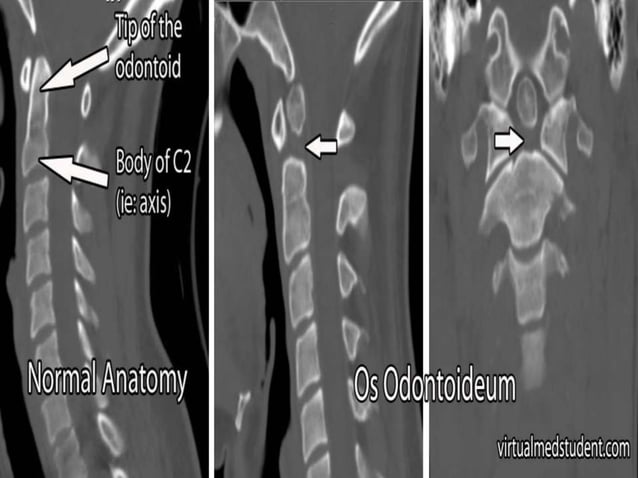 classification and managenement of paediatric craniocervical junction ...