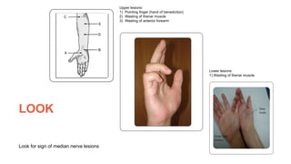 Peripheral nerve examination of upper limb.pptx