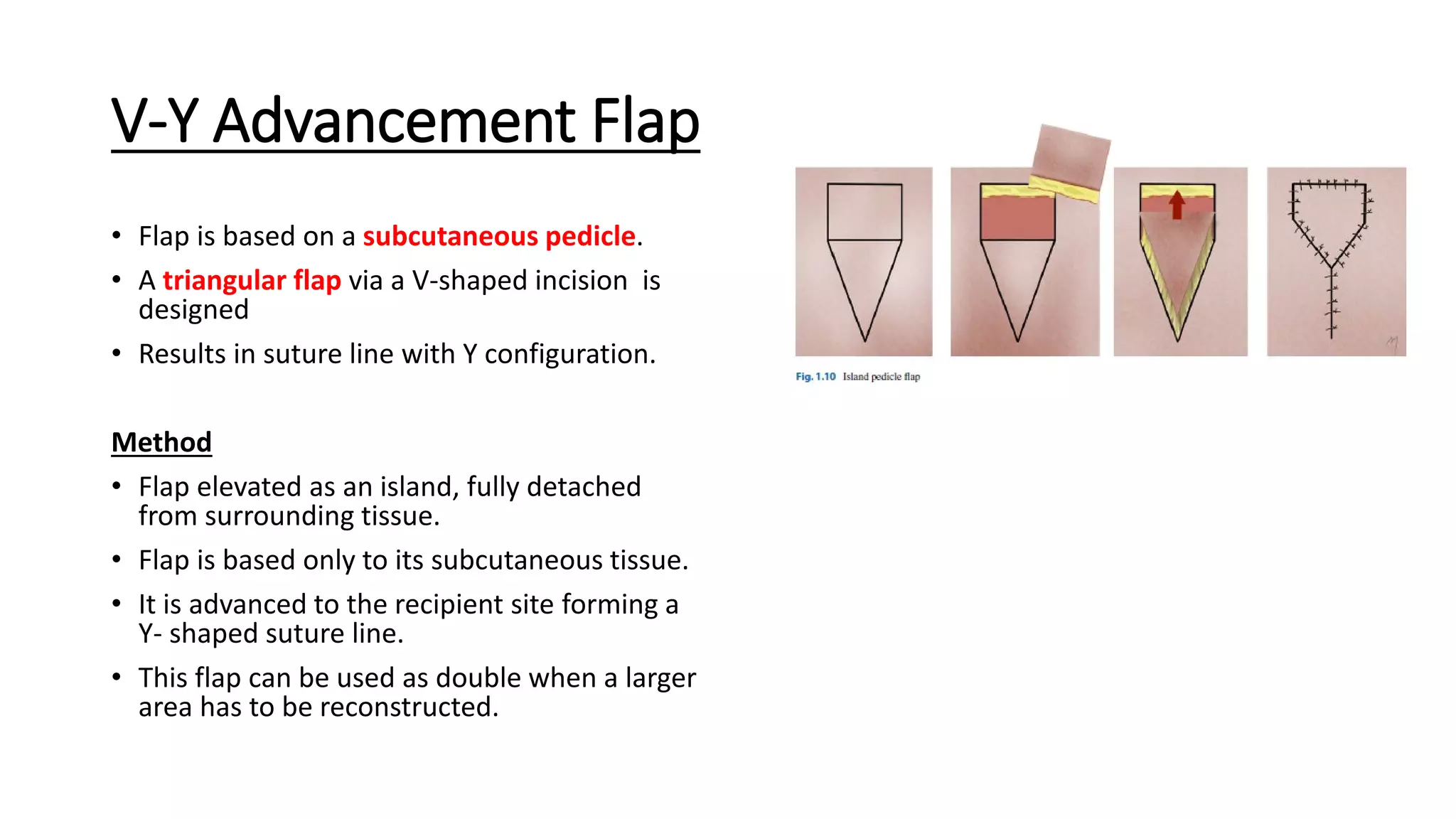 Basic Principles of Flap | PDF