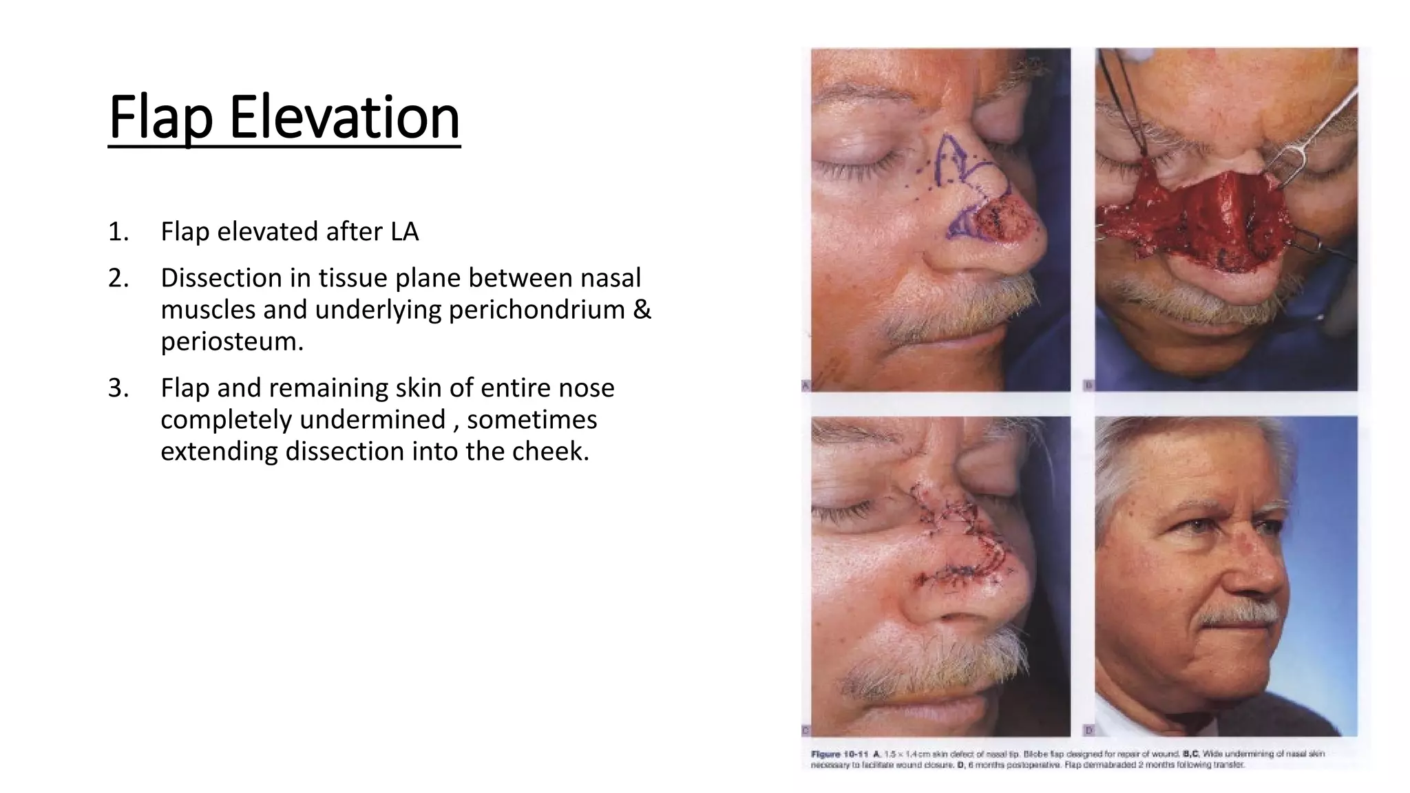 Basic Principles of Flap | PDF