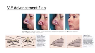 Basic Principles of Flap | PDF