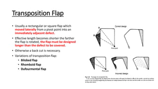 Transposition Flap