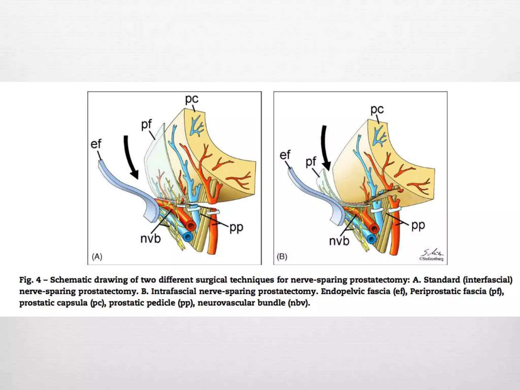 Prostate - Clinical Anatomy as applied to Prostate Cancer | PPTX