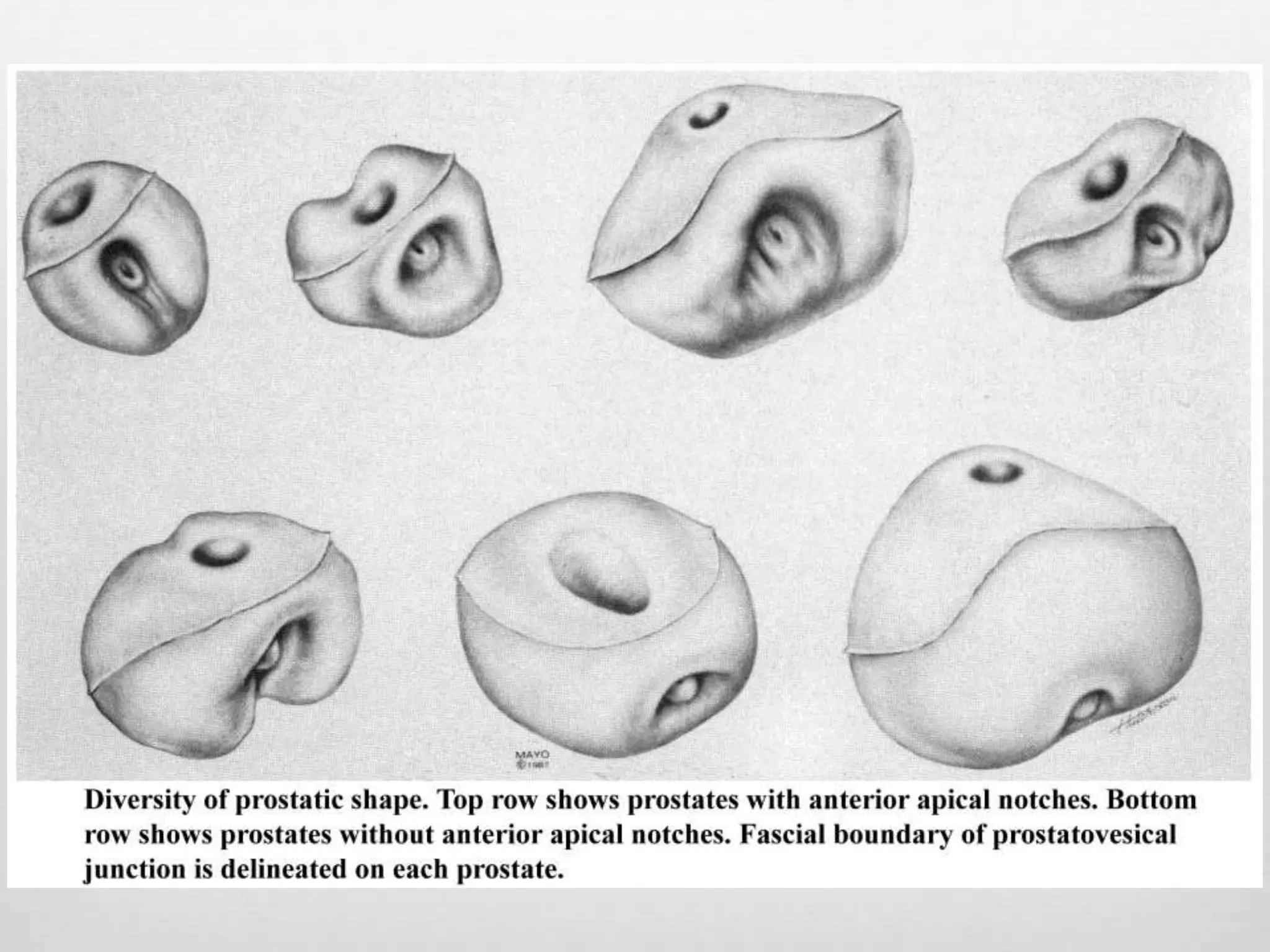 Prostate - Clinical Anatomy as applied to Prostate Cancer | PPTX