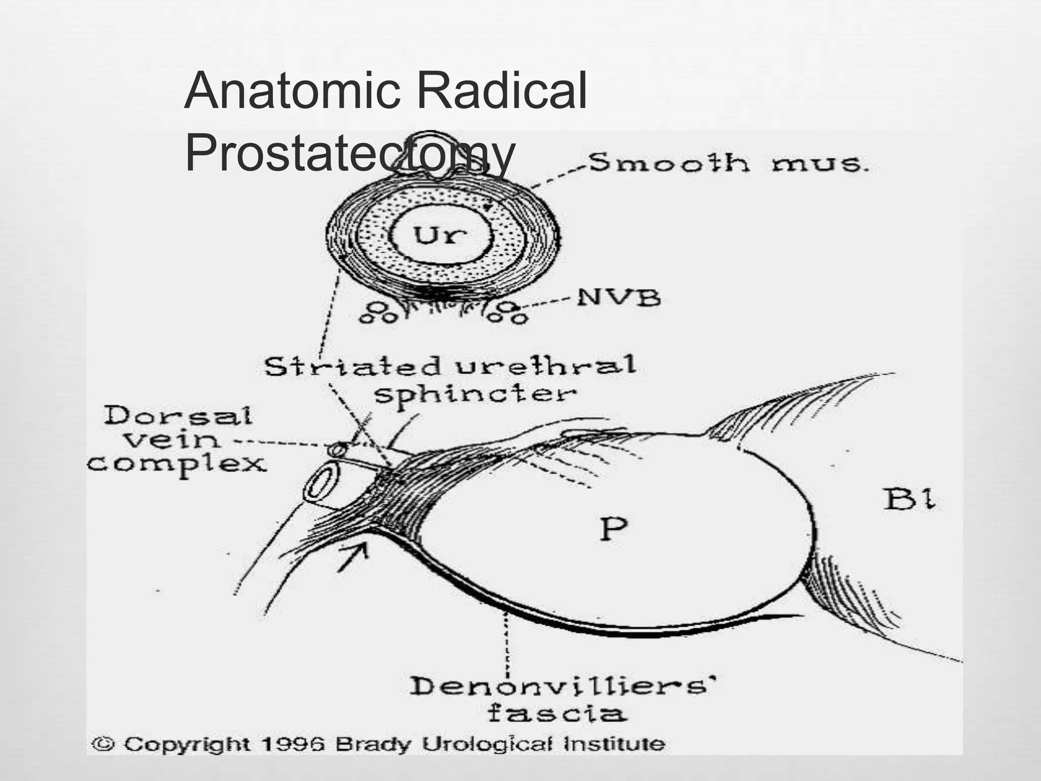 Prostate - Clinical Anatomy as applied to Prostate Cancer | PPTX