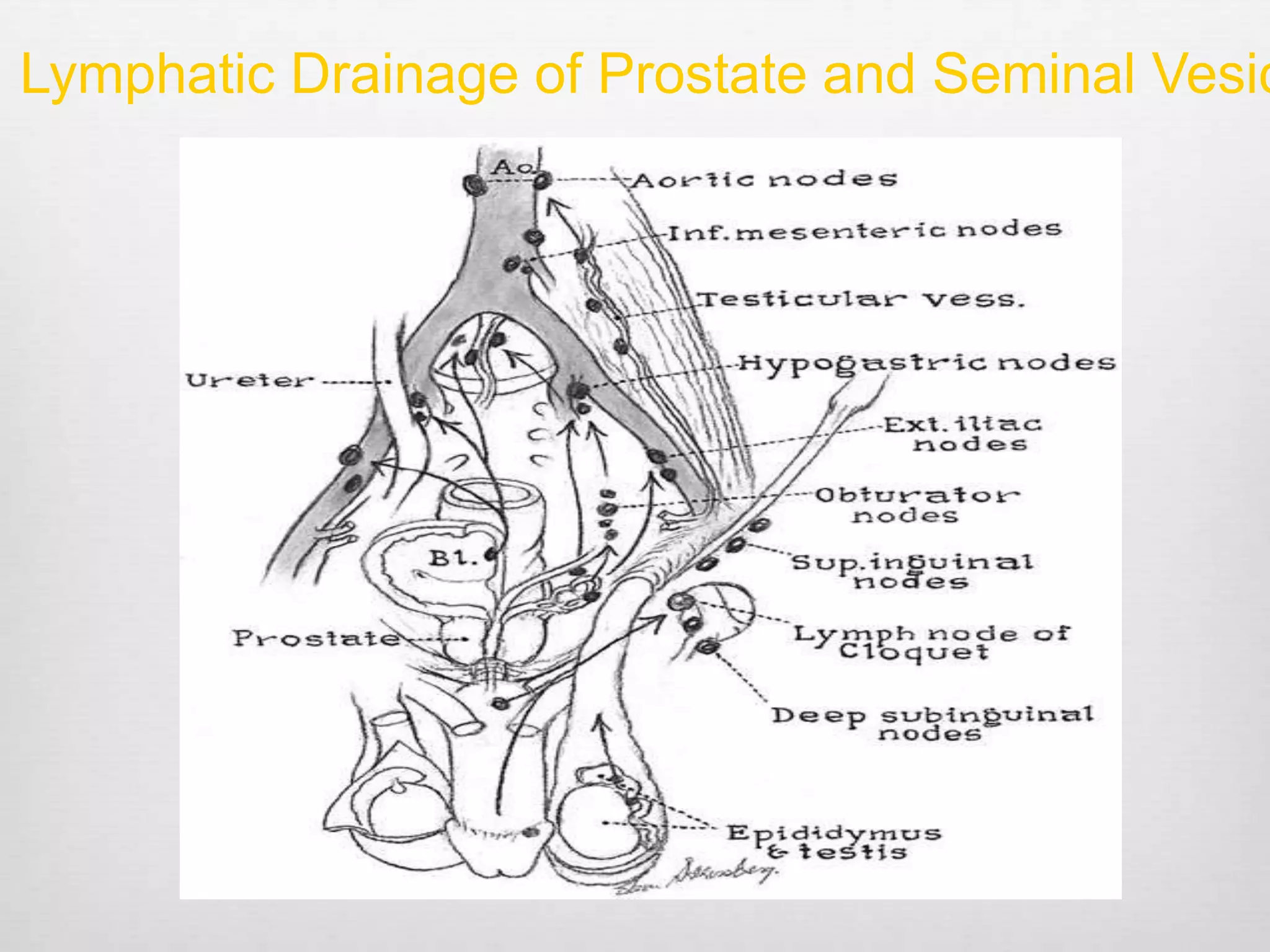 Prostate - Clinical Anatomy as applied to Prostate Cancer | PPTX