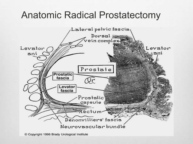 Prostate - Clinical Anatomy as applied to Prostate Cancer | PPTX ...