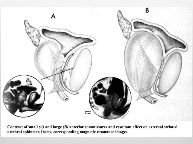 Prostate - Clinical Anatomy as applied to Prostate Cancer | PPTX ...