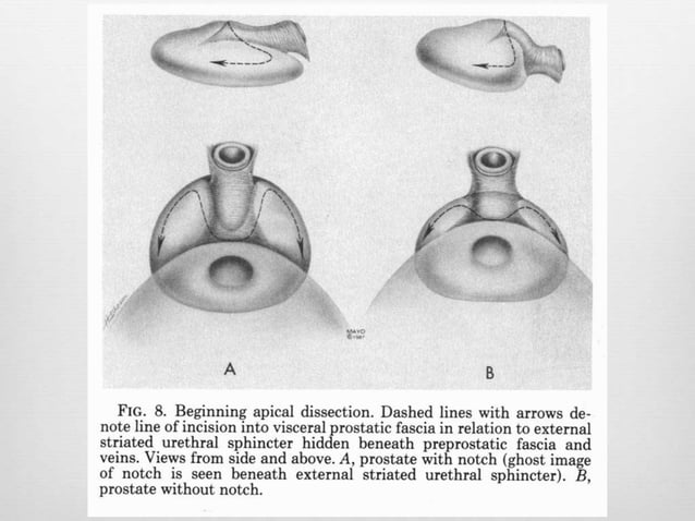 Prostate - Clinical Anatomy as applied to Prostate Cancer | PPTX ...