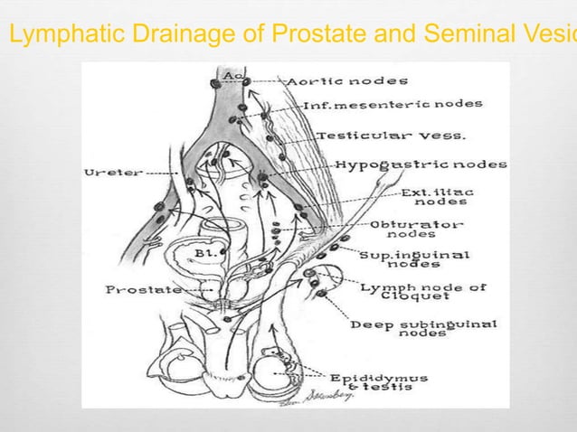 Prostate - Clinical Anatomy as applied to Prostate Cancer | PPTX ...
