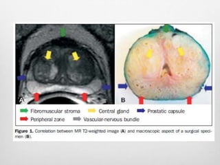 Prostate - Clinical Anatomy as applied to Prostate Cancer | PPTX