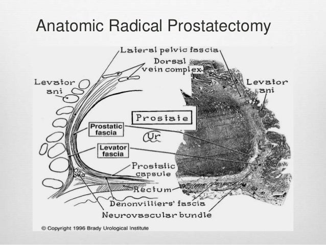 Prostate - Clinical Anatomy as applied to Prostate Cancer