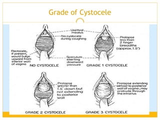 Cystocele Grading