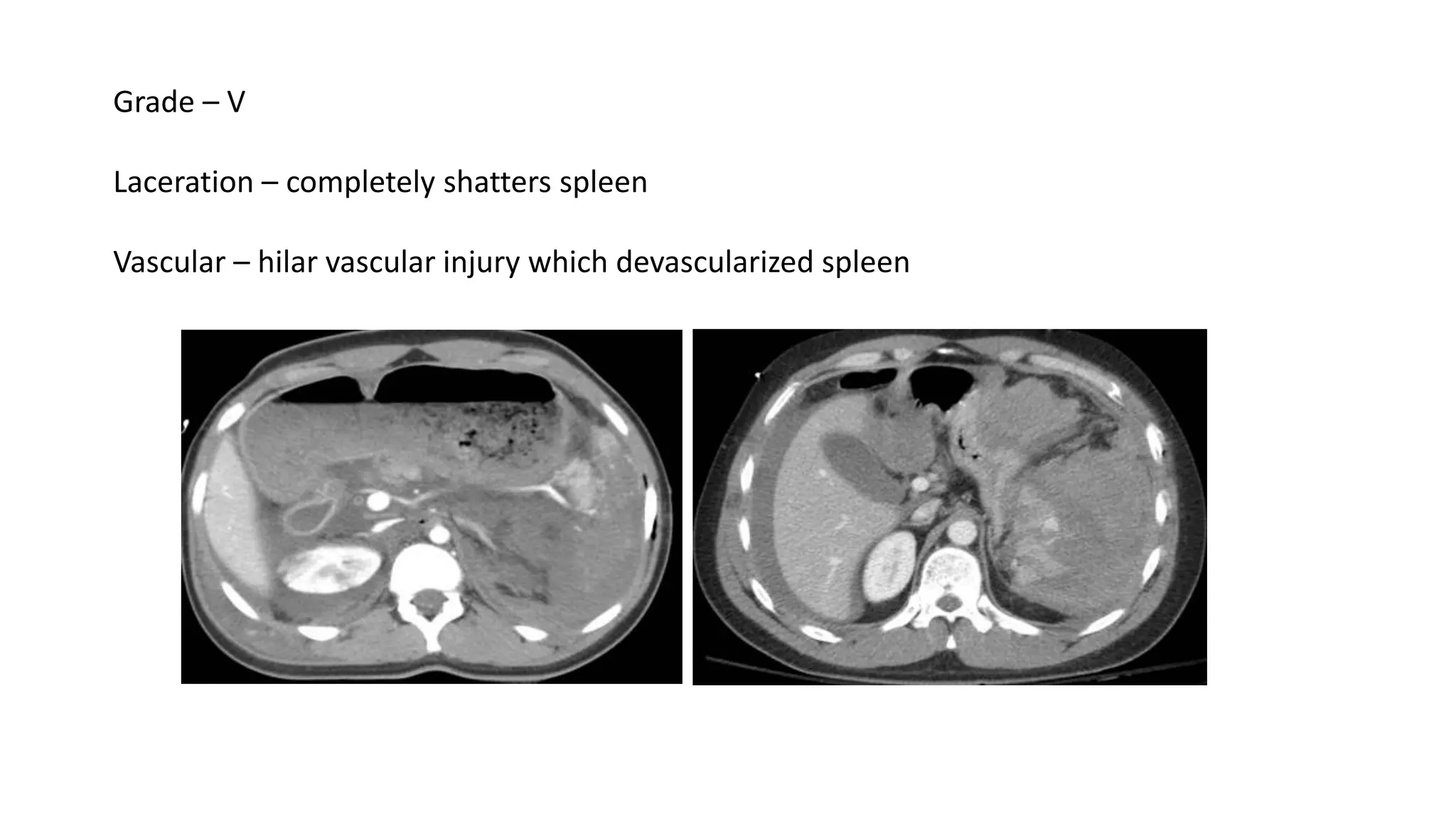 CME splenic injury.pptx