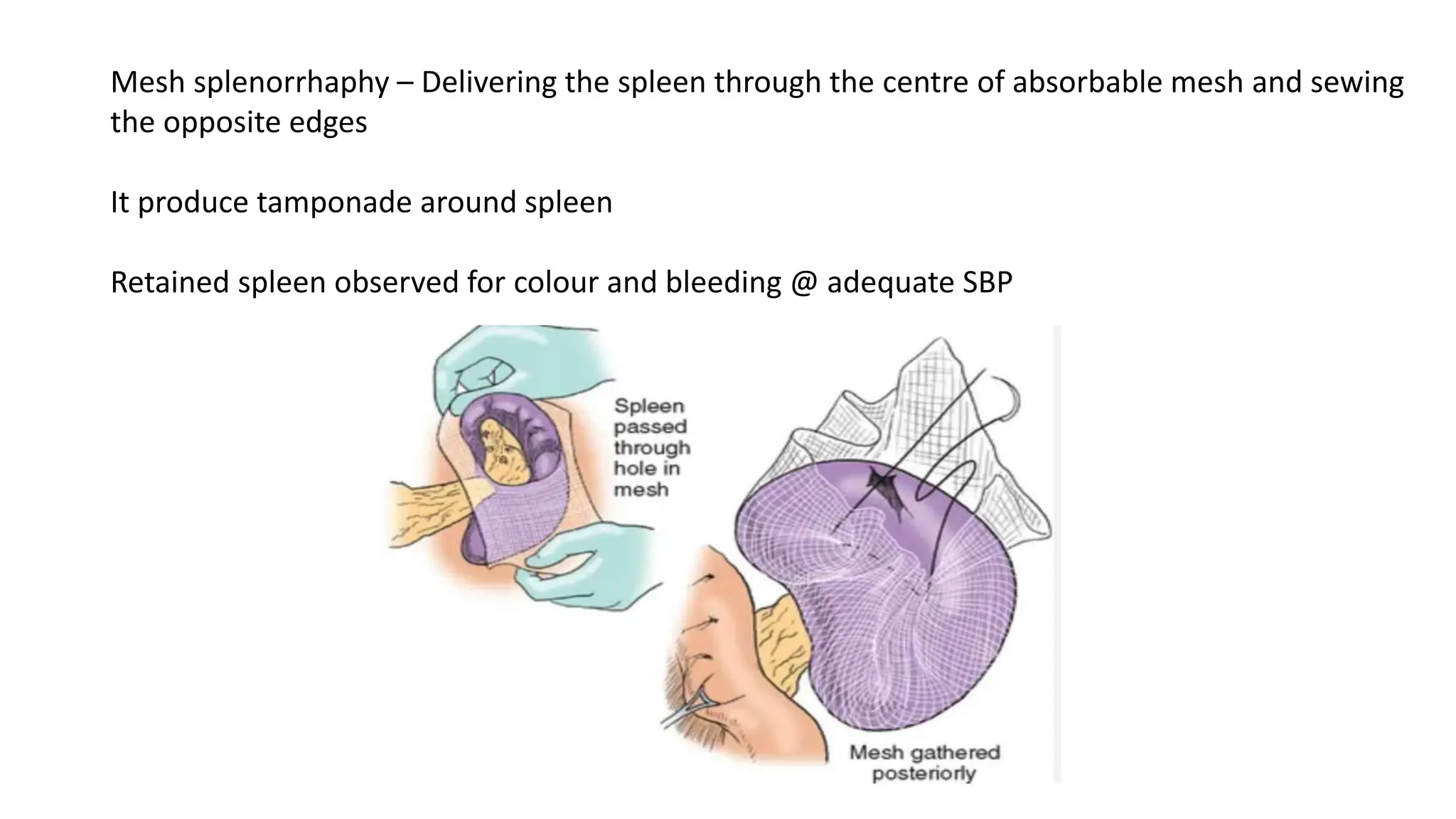 CME splenic injury.pptx