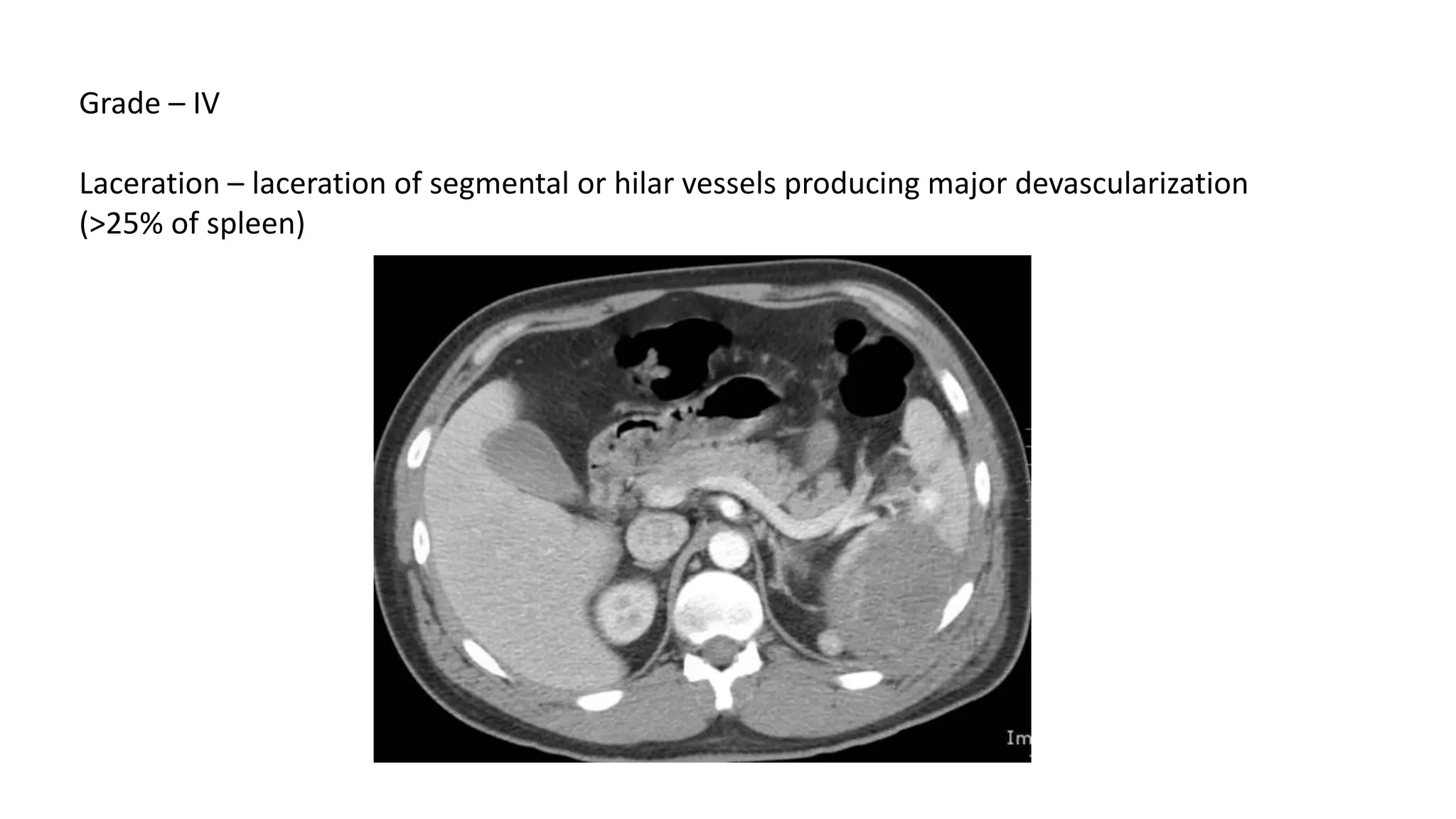CME splenic injury.pptx