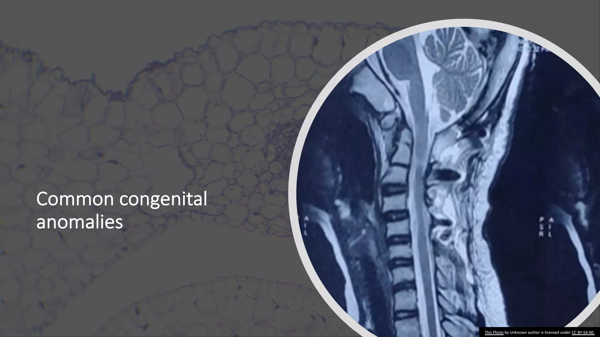 Human Birth Defects and Common congenital anomalies | PDF