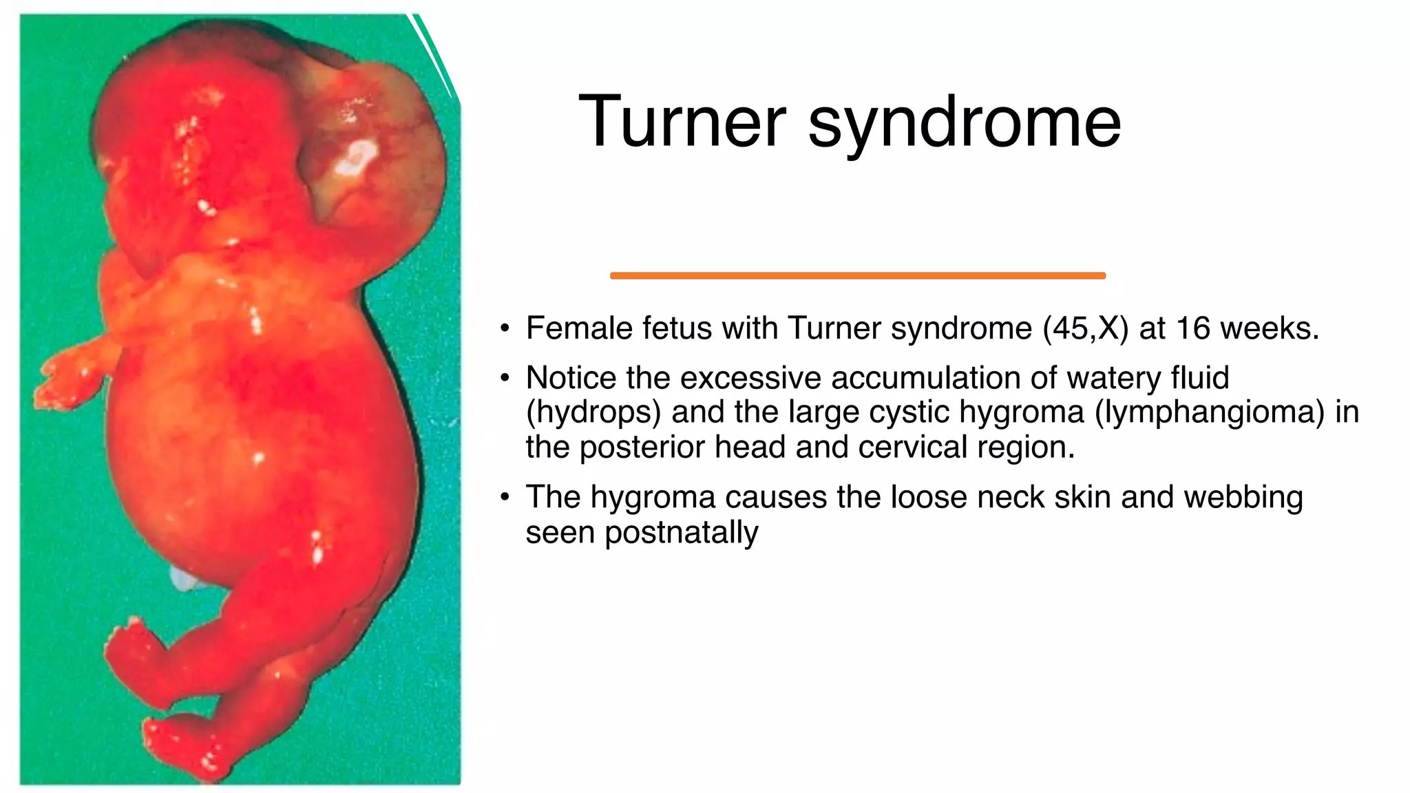 Human Birth Defects and Common congenital anomalies | PDF