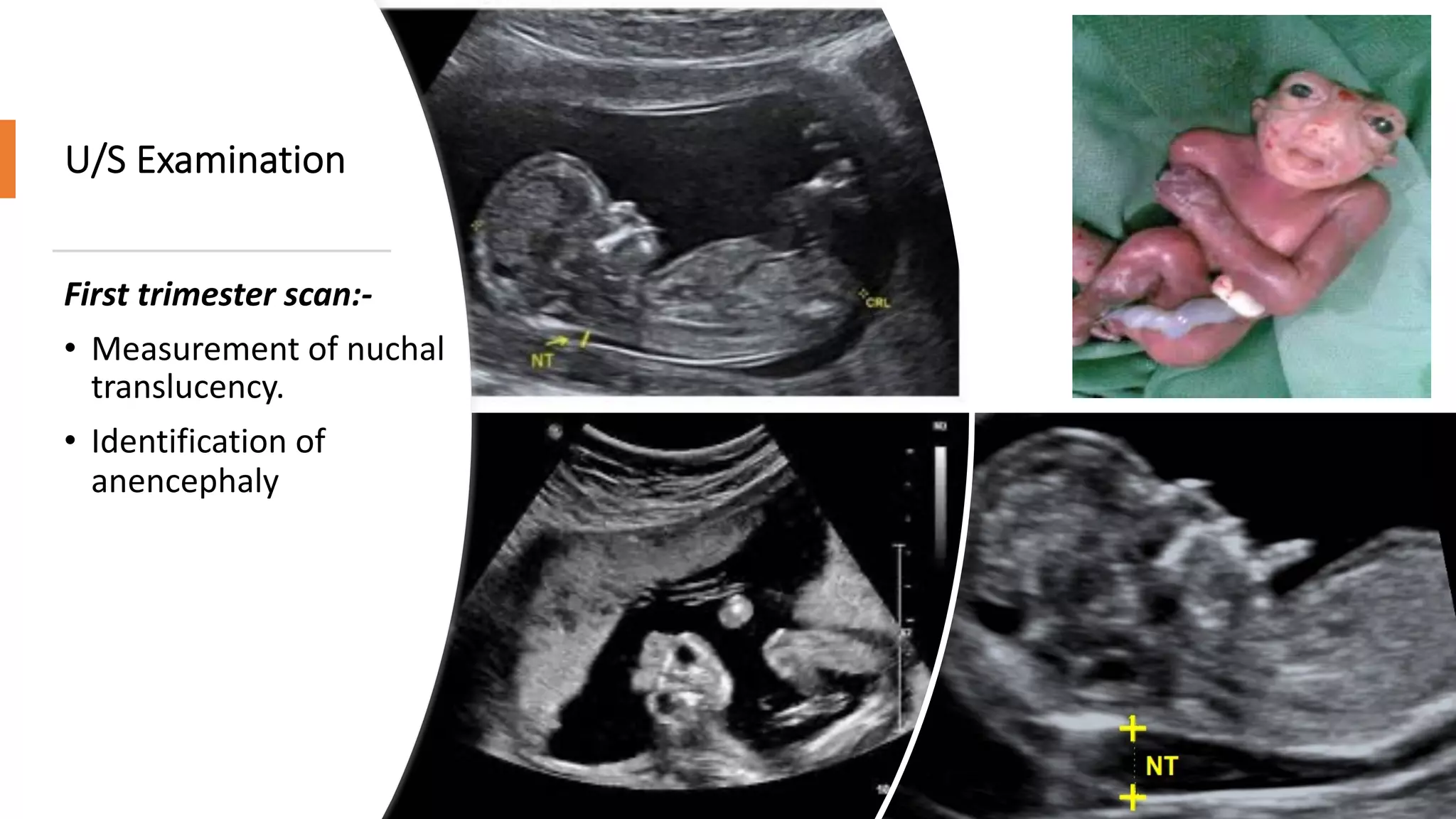 Human Birth Defects and Common congenital anomalies | PDF