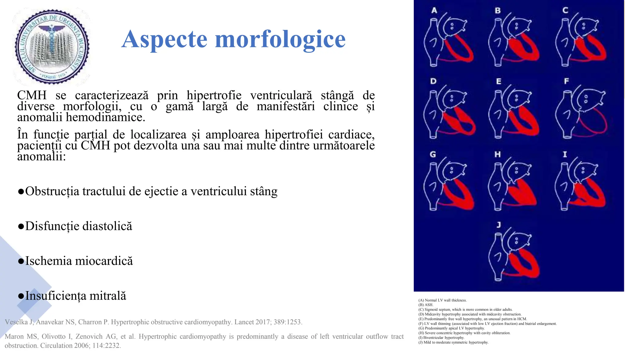 Cardiomiopatia hipertrofica obstructiva.pptx