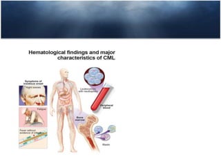 Chronic Myeloid Leukemia | PPTX