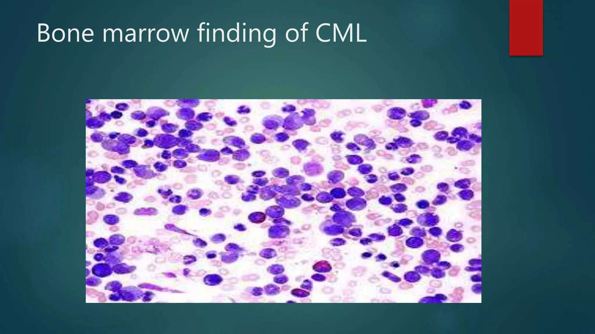 Myeloproliferative disease- CML | PPTX