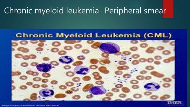 Myeloproliferative disease- CML | PPTX | Blood Disorders | Diseases and ...