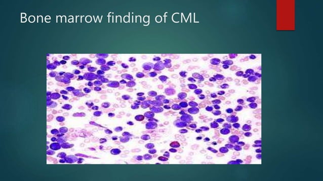 Myeloproliferative disease- CML | PPTX | Blood Disorders | Diseases and ...