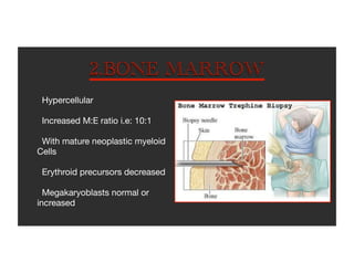 CML.PPT,CHRONIC MYELOID LEUKEMIA:HEMATOLOGY | PDF